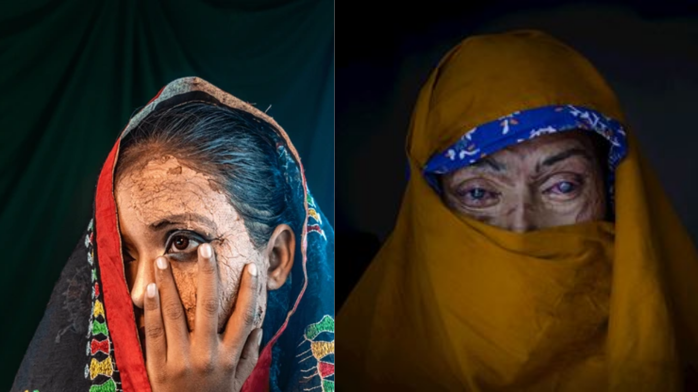 Acid Attack on Woman by Brother-in-Law After She Rejects Marriage Proposal! | InsightRush
